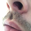 How Many Types of Septoplasty Incision Techniques Are Offered? Doctor ...