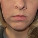 Procedures to Improve Bottom Heavy Face? Doctor Answers, Tips