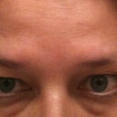 Botox Caused Droopy "Captain Spock" Eyes - Help! Doctor Answers, Tips