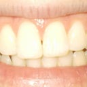 I have two front teeth that are longer than my other teeth. Can they be ...