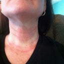 Is it normal to get a rash from Ultherapy? When should I expect it to ...