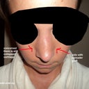 One Sided Inverted V Deformity? or Full Inverted V Deformity? (photo ...