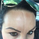 Vertical dent in forehead. Any suggestions? (photos) Doctor Answers, Tips