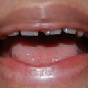 Why are my upper lips drooping, What options do I have to fix it ...