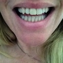 What Can I Do to Fix Off-centered Teeth? (photo) Dentist Answers, Tips