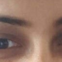 Dark areas between nose and eye--maybe veins? (Photo) Doctor Answers, Tips