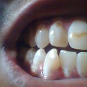 Can Mottling Of Teeth be Cured Completely? (photo) Doctor Answers, Tips