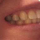 What options are there to fixing my large lateral and central incisors ...