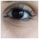 What are these lines called under my eyes above my cheeks, and how can ...