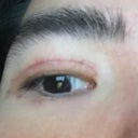 Upper and Lower Eyes Surgery, Day 18: The deep scars are my concern ...