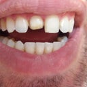 3/4 crowns on four front teeth? (photos) Doctor Answers, Tips