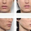 Can Nose Surgery Fix a Short Upper Lip? (photo) Doctor Answers, Tips