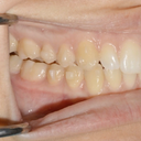 Can Invisalign Fix the Gap Between Top and Bottom Teeth? Dentist ...