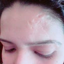 How Do I Get Rid of These Scar Tissue Bumps on my Scar? (photo) Doctor ...