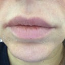 Can a philtrum injection define the philtrum lines without accentuating ...