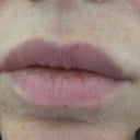 Can a philtrum injection define the philtrum lines without accentuating ...