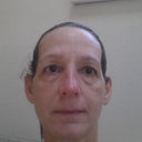 Can Temporalis Muscle Wasting from Botox Be Reversed? (photo) Doctor ...