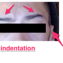I have indentations on both sides of my forehead after rhinoplasty ...