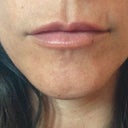 Dent Above Upper Lip After Juvederm? (photo) Doctor Answers, Tips