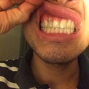 How to Deal With Mild Overcrowding of Teeth? (photo) Dentist Answers, Tips