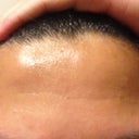 Is it possible to remove hard lump on forehead caused by bumping head ...