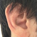 Conchal Bowl Swelling/excess Skin After Otoplasty? (photo) Doctor ...