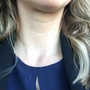 Deep Neck Lines and Folds. (photo) Doctor Answers, Tips
