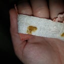 I Had a Tummy Tuck 3 Weeks Ago and Now my Belly Button Looks Infected ...