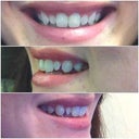 Porcelain Crown Vs Porcelain Veneers for Peg Laterals After Braces ...