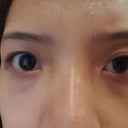 One eye suddenly smaller than the other. What could this be from ...