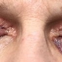 Are Incisions for Upper and Lower Eyelid Surgery Suppose to Extend over ...