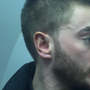 Bulging Zig Zag temple veins. Is there any way to get rid of them ...