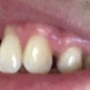 Solutions for this "bullfrog neck," jowling, chipmunk cheeks, recessed ...