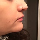 Ugly side profile, how to fix? (photos) Doctor Answers, Tips