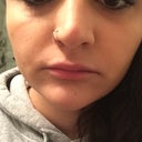 Ugly side profile, how to fix? (photos) Doctor Answers, Tips