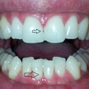Invisalign and Black Triangles? (photo) Dentist Answers, Tips