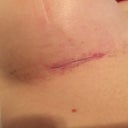 Is redness & a little tenderness normal in incisions 7 weeks post op ...