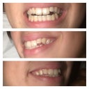 My Front Teeth Are Too Big! Can They Be Fixed? (photo) Doctor Answers, Tips