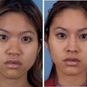 What causes triangular nostrils after rhinoplasty? (photo) Doctor ...