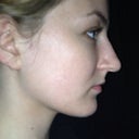 Correcting 8mm Anterior Overjet with Increased Overbite with Invisalign ...