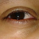 What's the best treatment for dents on the side of my eyes after lower ...