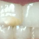 What is this dark yellow spot on my tooth? (photos) Doctor Answers, Tips