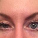 Is Continual Use of Iopidine for Drooping Eyelids from Botox Safe ...