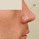Dip in Nose After Rhinoplasty. What's a Permanent Solution? Doctor ...